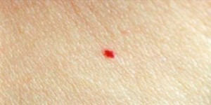 Lunares rojos en la piel: ¿A qué se deben?