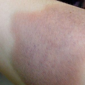 5 cosas que debes saber sobre los moretones - Supercurioso