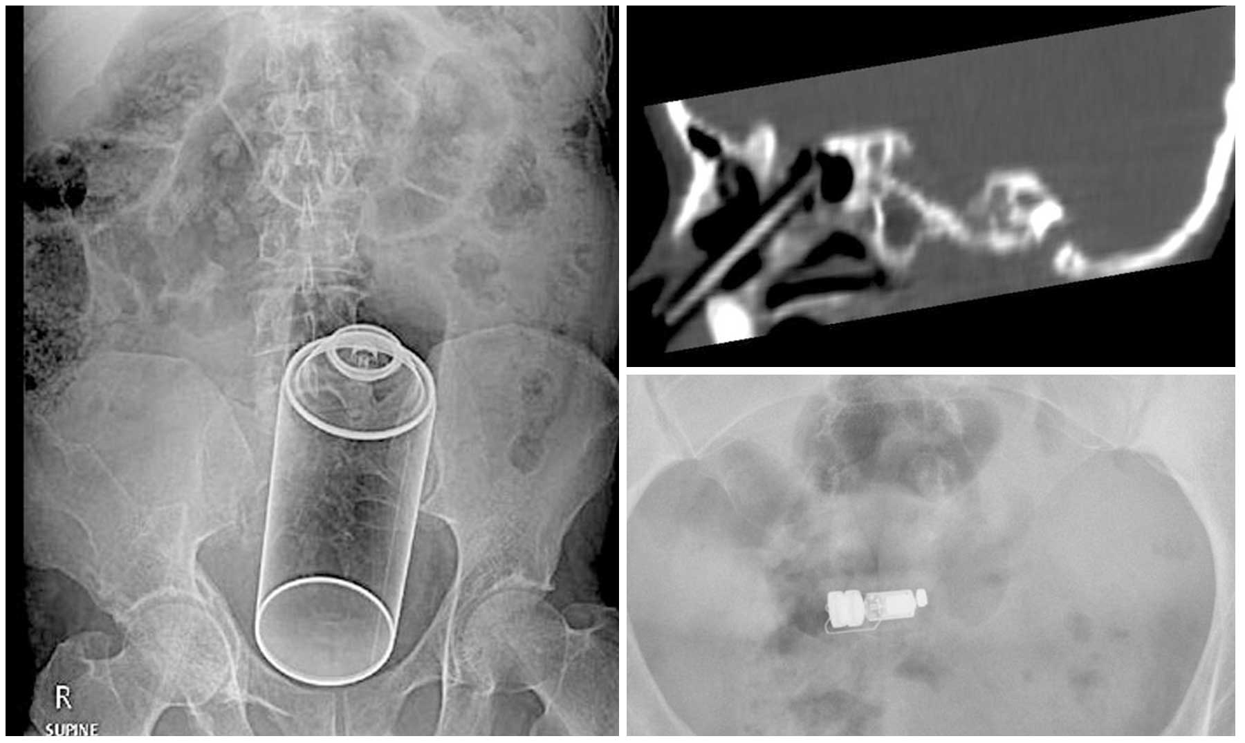 Cuerpos extraños en agujeros humanos. ¡Sorprendentes!