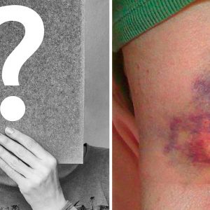 Por-qué-cambian-de-color-los-moretones-Te-lo-explicamos - Supercurioso