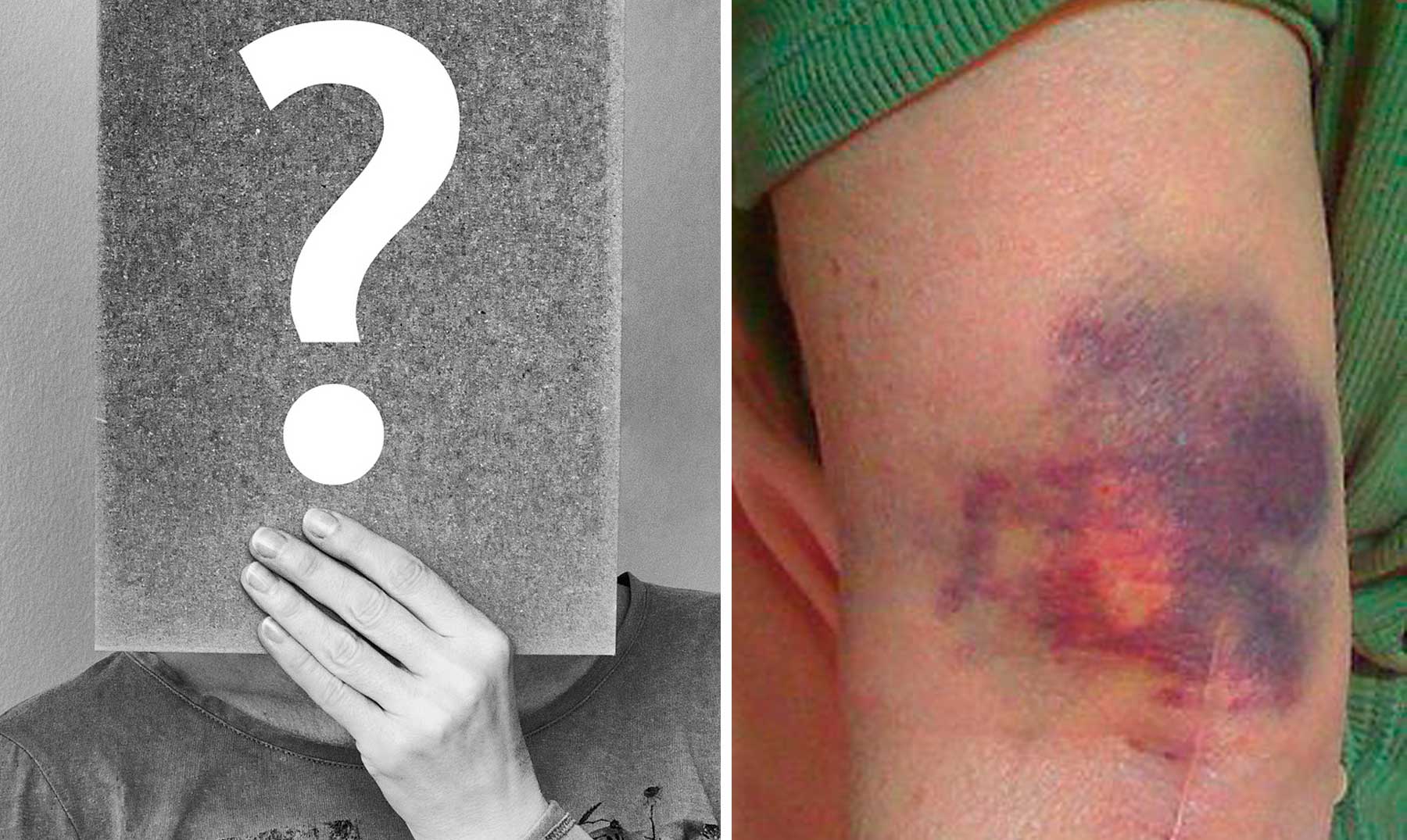 ¿Por qué cambian de color los moretones? Te lo explicamos